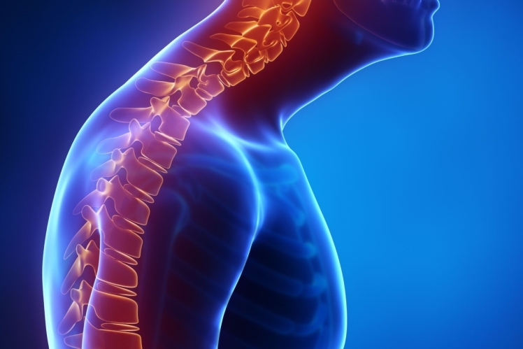 ¿Cómo corregir la hipercifosis con Pilates?