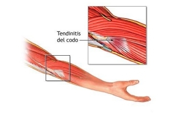 La temida tendinitis