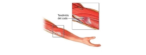La temida tendinitis