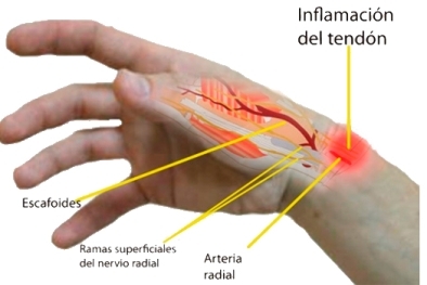 La temida tendinitis